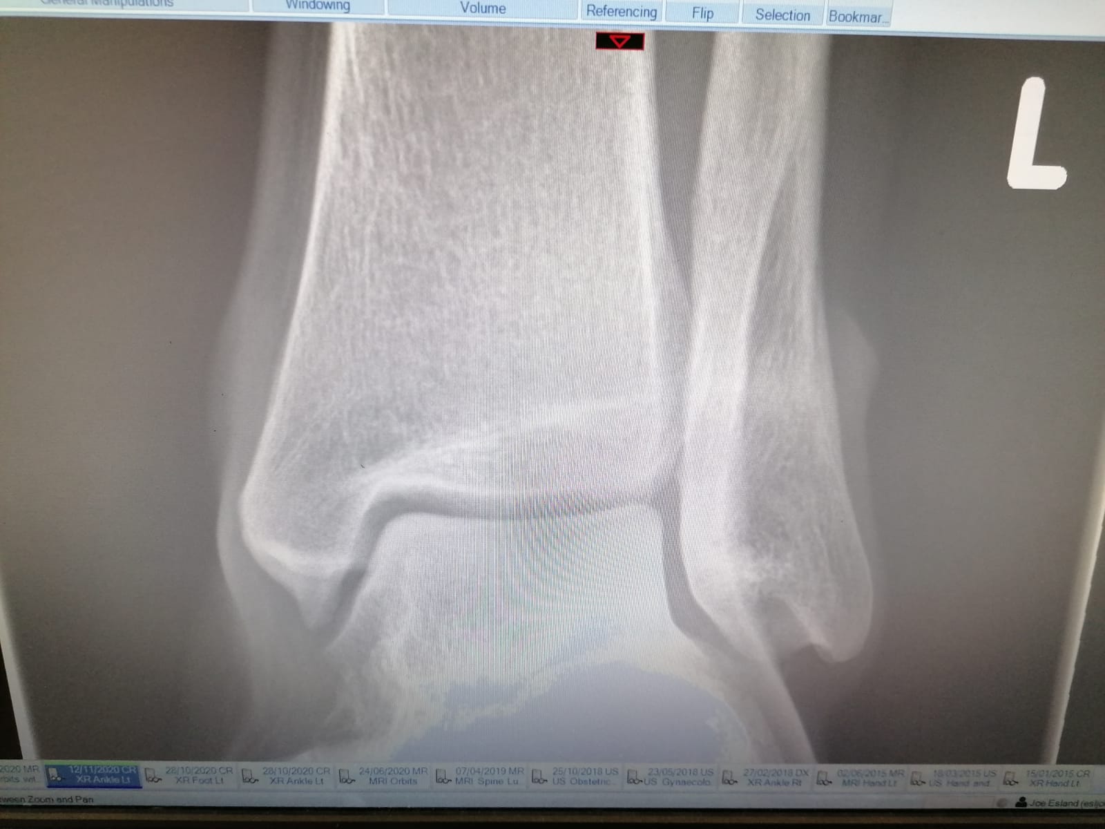 Focus Shockwave Therapy V Radial Shockwave Therapy - Osteopath Edinburgh